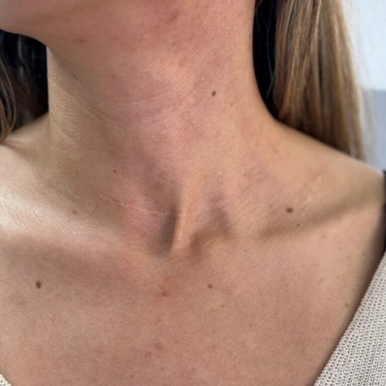 Cicaderm Para el cuidado de la piel